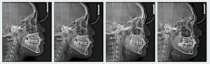 Corrective Jaw Surgery: Process and Benefits - Utah Oral Surgeons